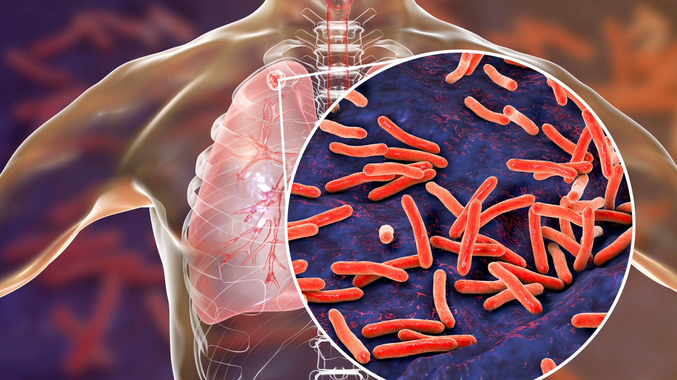 What You Need to Know About Tuberculosis (TB) For The NCLEX Exam